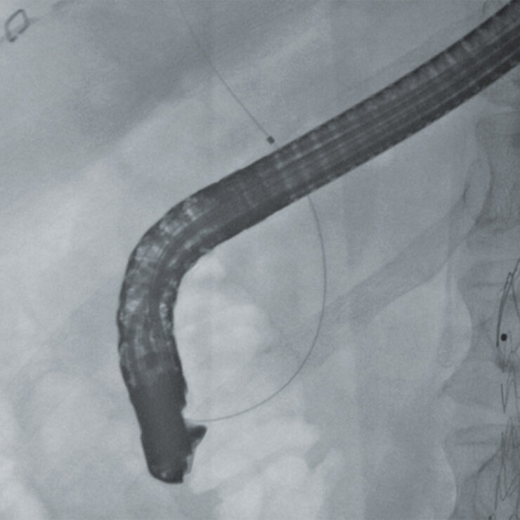 Biliary Longwire Guidewires - Micro-Tech UK